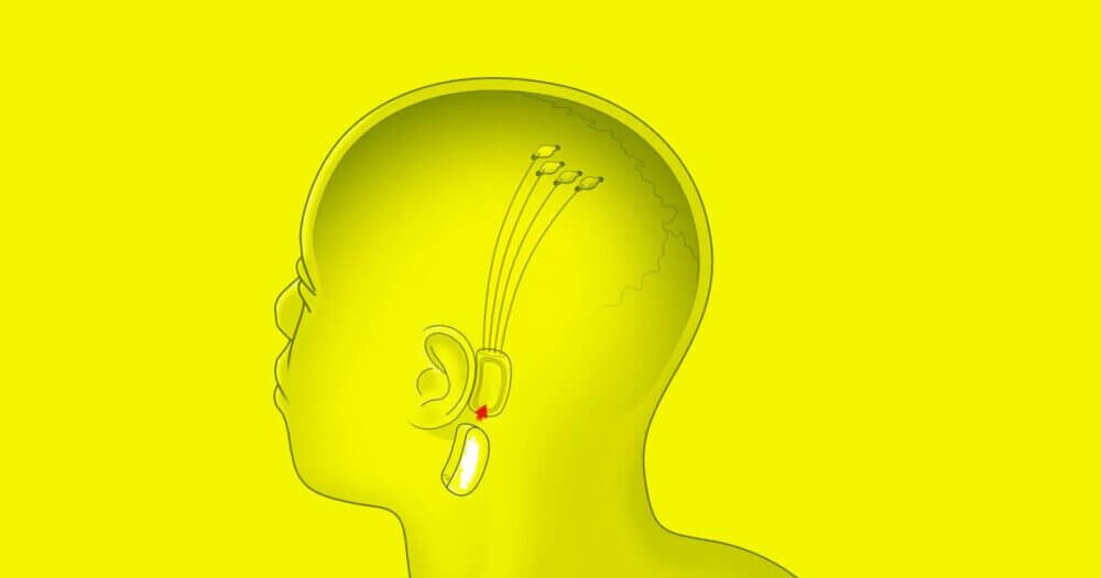 Neuralink: Elon Musk quer instalar um chip em nossos crânios - Update ...